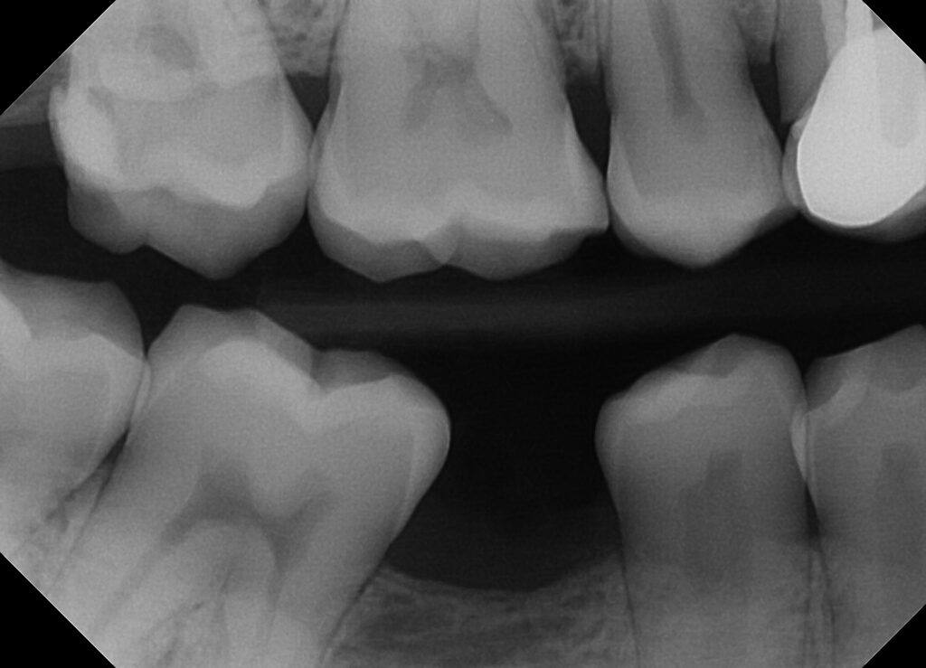 Stages of Tooth Decay - Smile Corners Dental