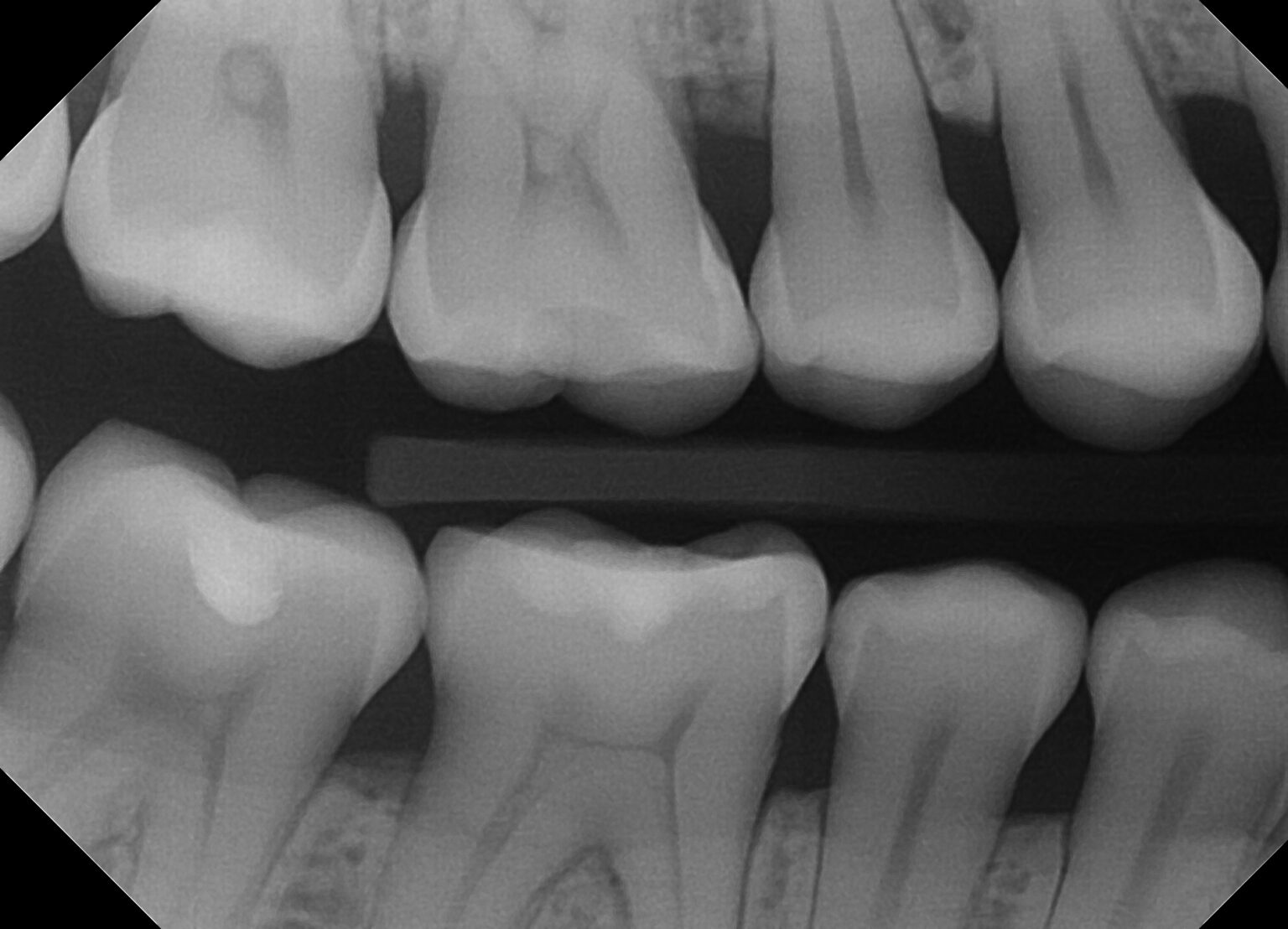 Stages of Tooth Decay - Smile Corners Dental