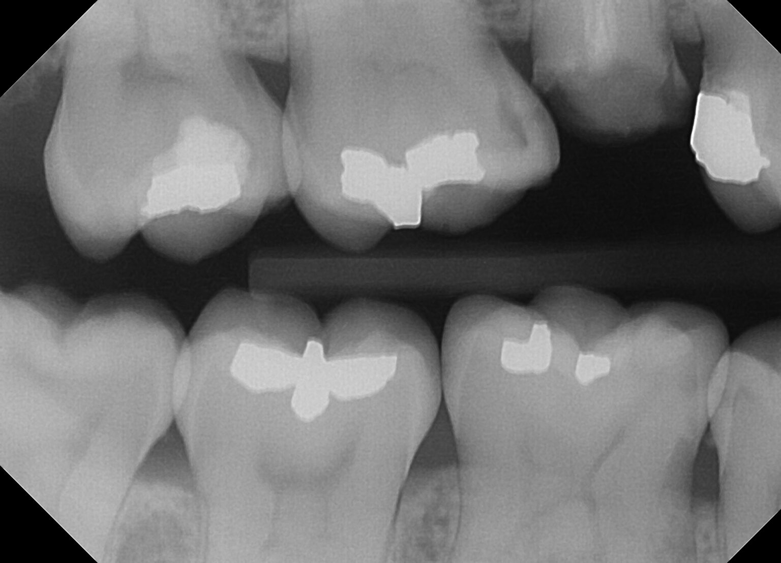 Stages of Tooth Decay - Smile Corners Dental