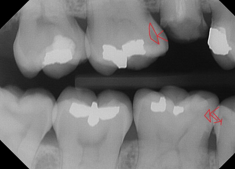 Stages of Tooth Decay - Smile Corners Dental