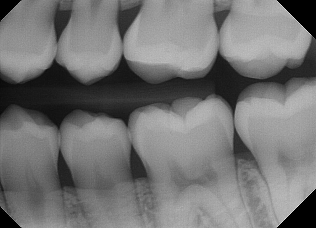 Stages of Tooth Decay - Smile Corners Dental
