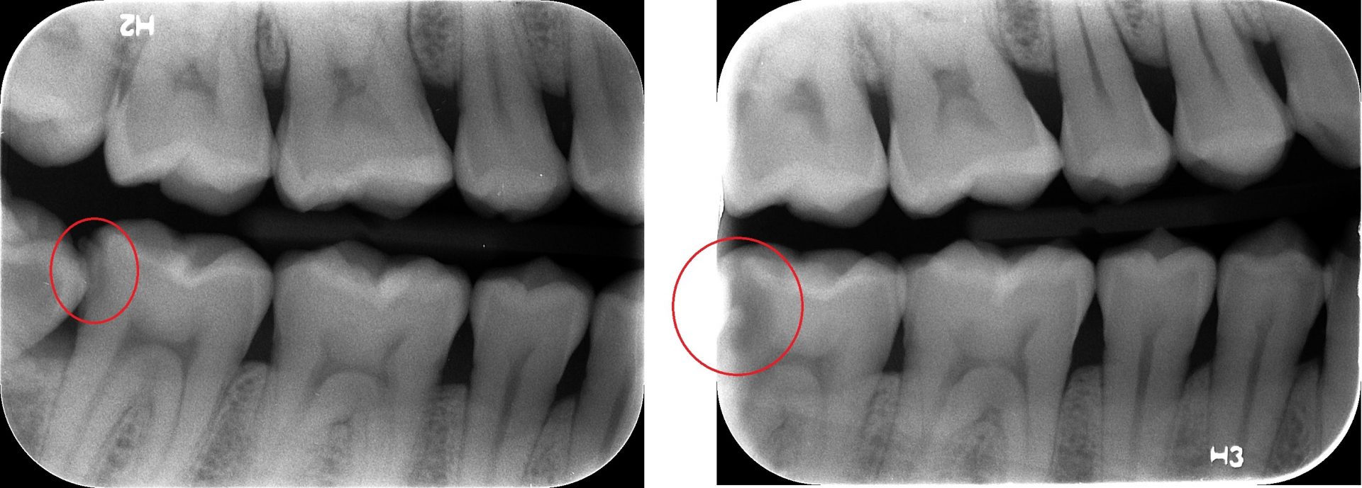 If I don’t treat a cavity, what could happen - Smile Corners Dental