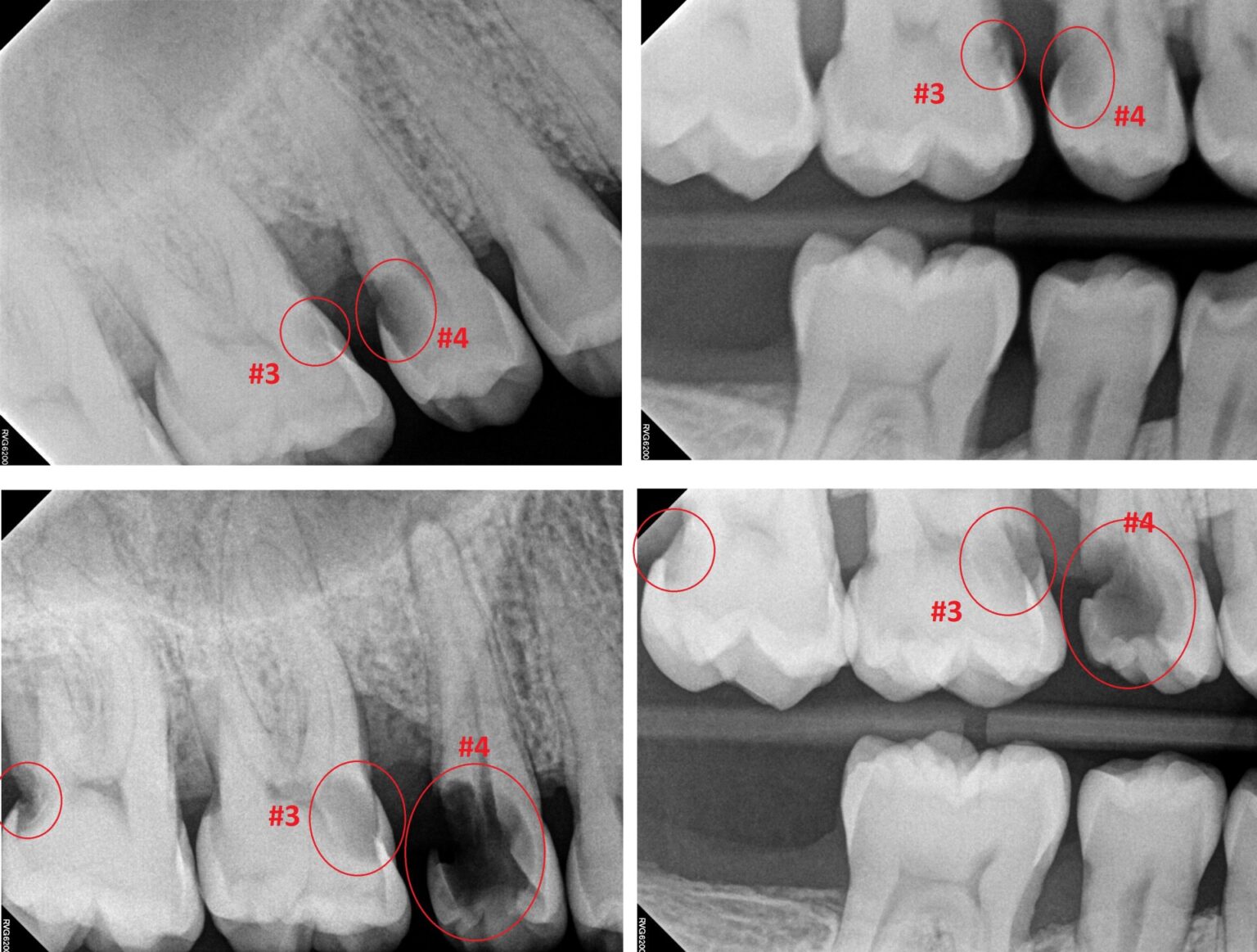 If I don’t treat a cavity, what could happen - Smile Corners Dental